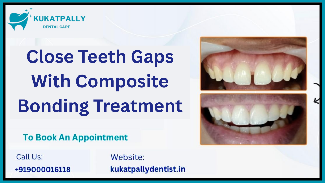 Best Close Teeth Gaps with Composite Bonding Treatment 2025